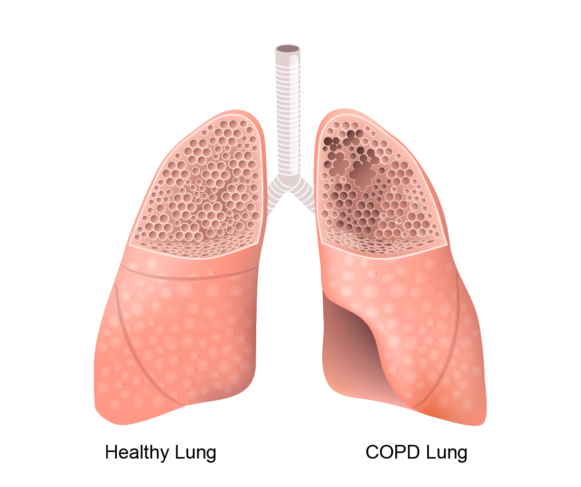 More Than a Measurement: COPD - A&D Medical